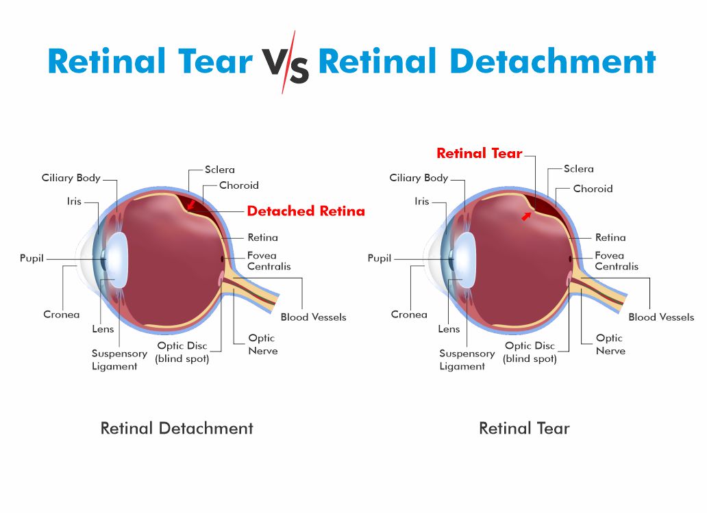 Retinal Tear Vs Retinal Detachment | Know The Differences