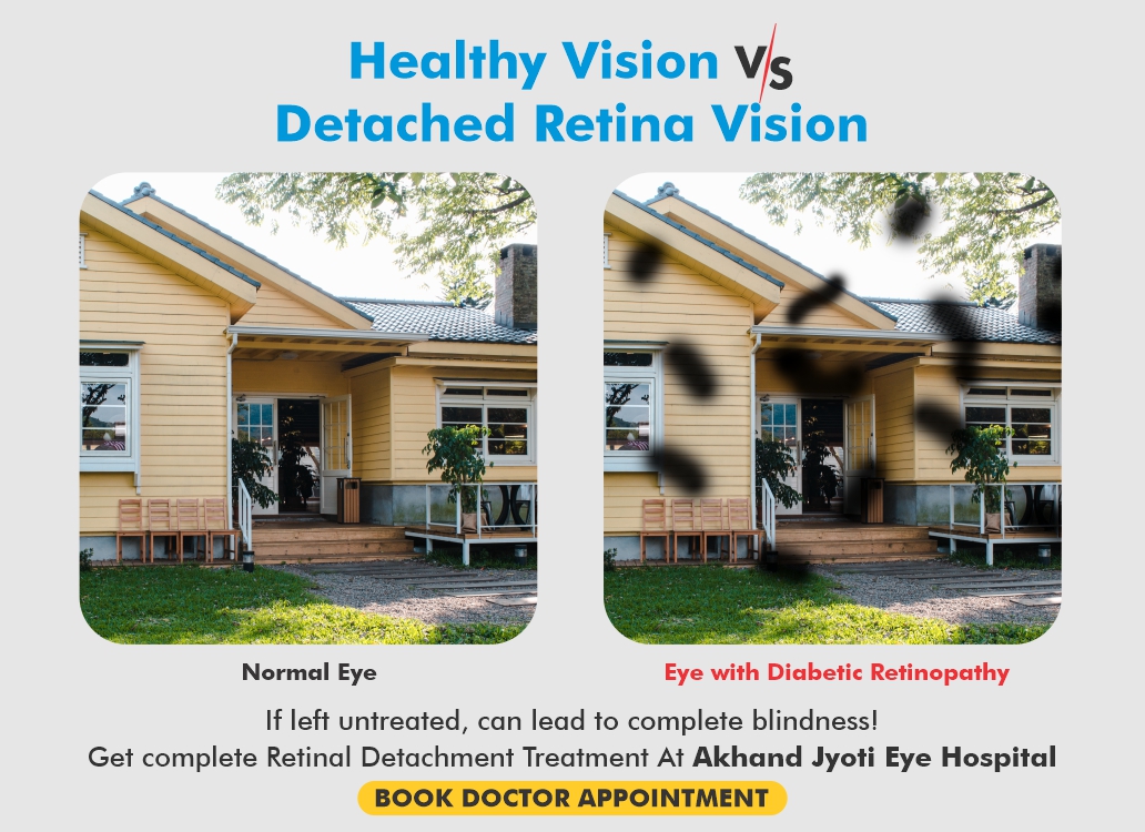 Retinal Detachment Treatment | Surgery & Laser Treatment