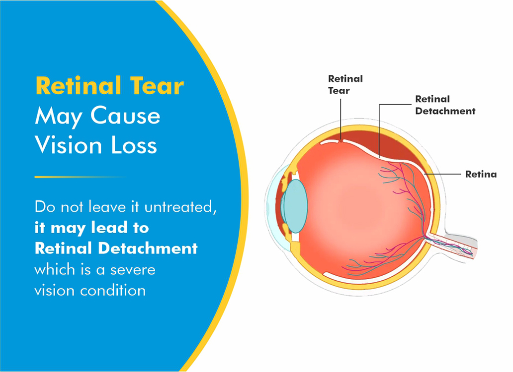 Is Retinal Tear A Medical Emergency? Facts To Know!