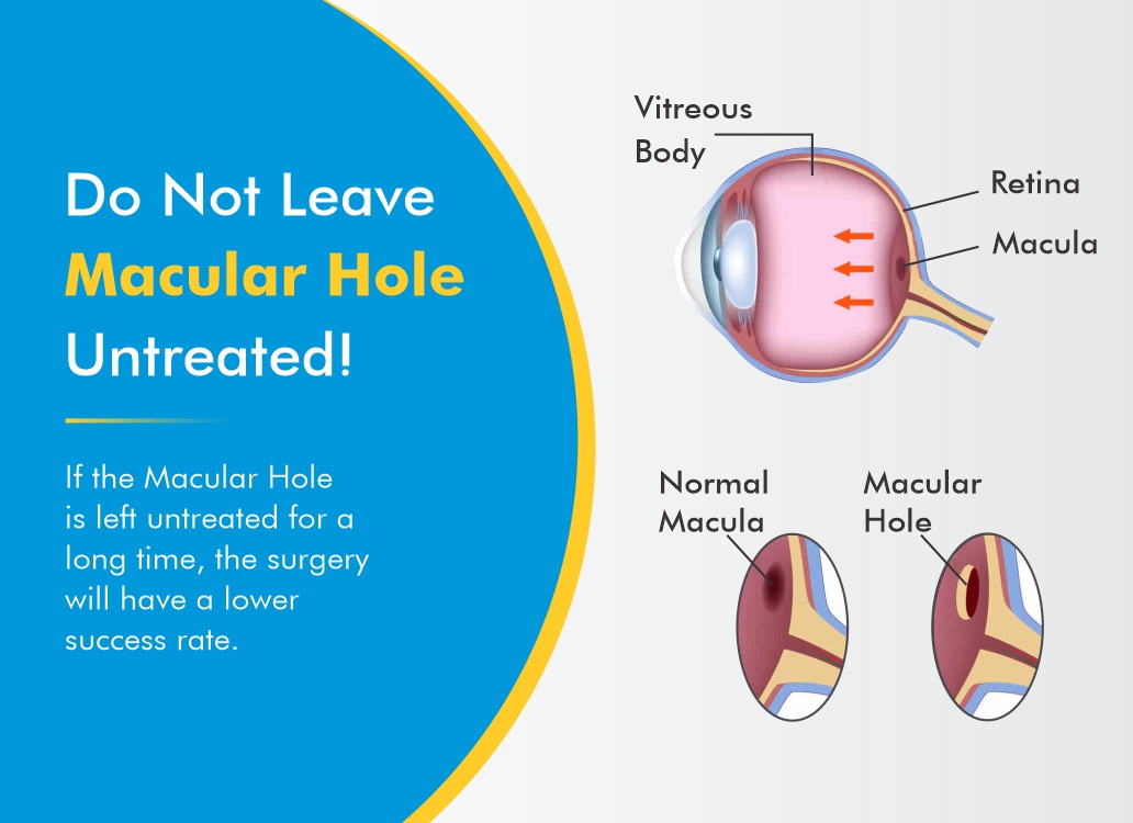 What is Macular Hole in Eye? Advanced Treatment & Surgery