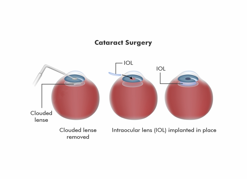 Cataract Surgery: Types, How it Works, Risks & Recovery Time